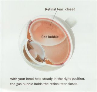 Detached & Torn Retina « Athens Retina Center