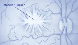 Macular Pucker « Athens Retina Center